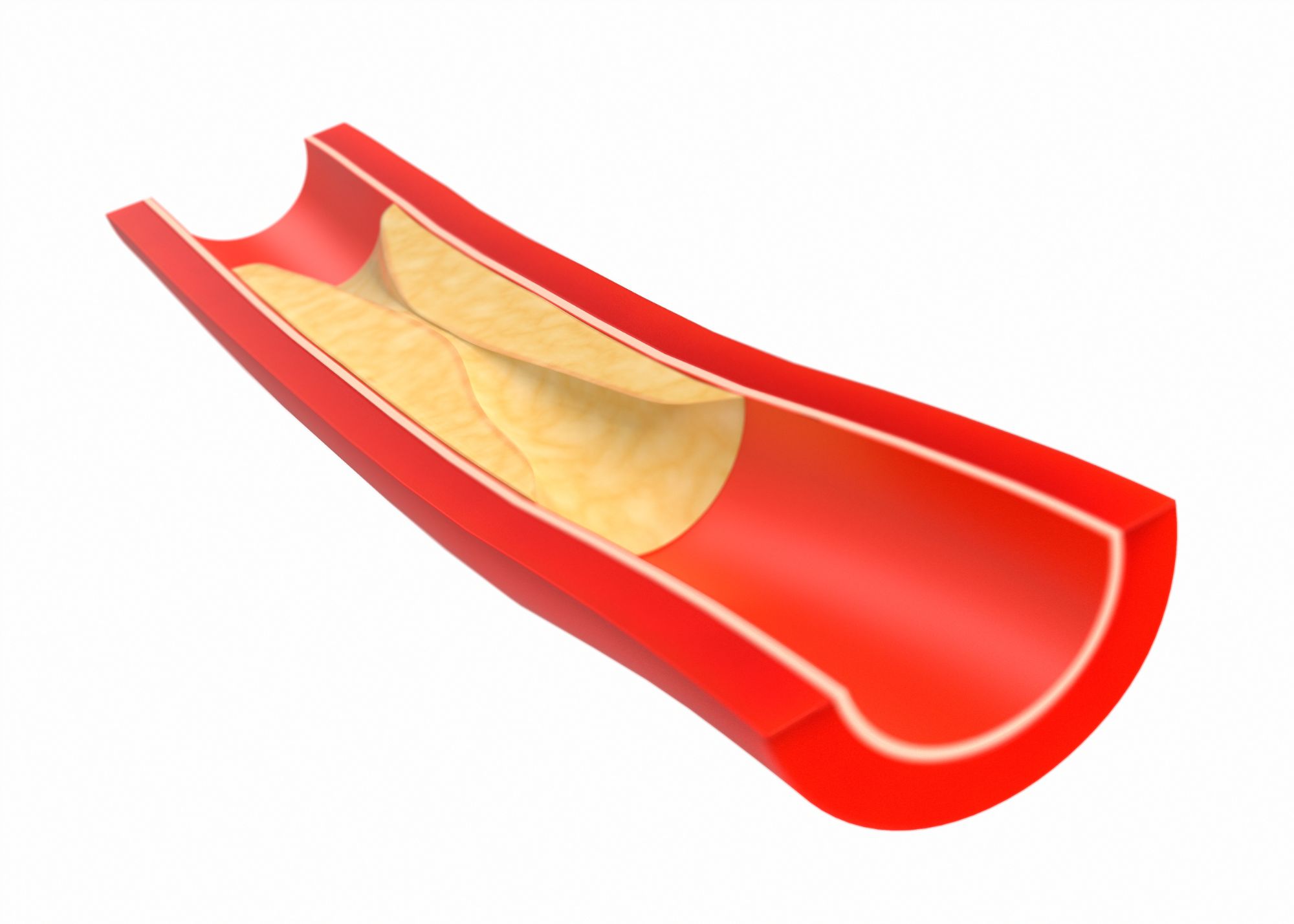 What is Carotid IMT (Intimal Media Thickness) Testing? - Forbes ...