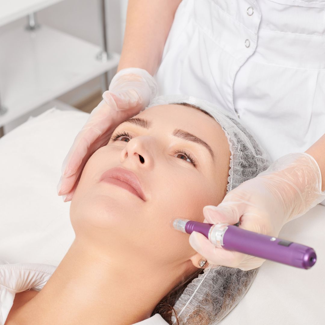 Radiofrequency Microneedling - Advanced Skin Revitalization